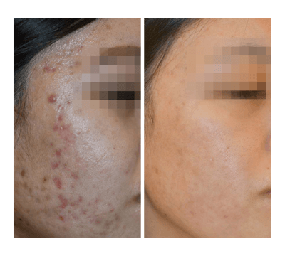 Ultra PicoPulse - Ultra Picopulse - Advanced Skincare Technology | One Doc